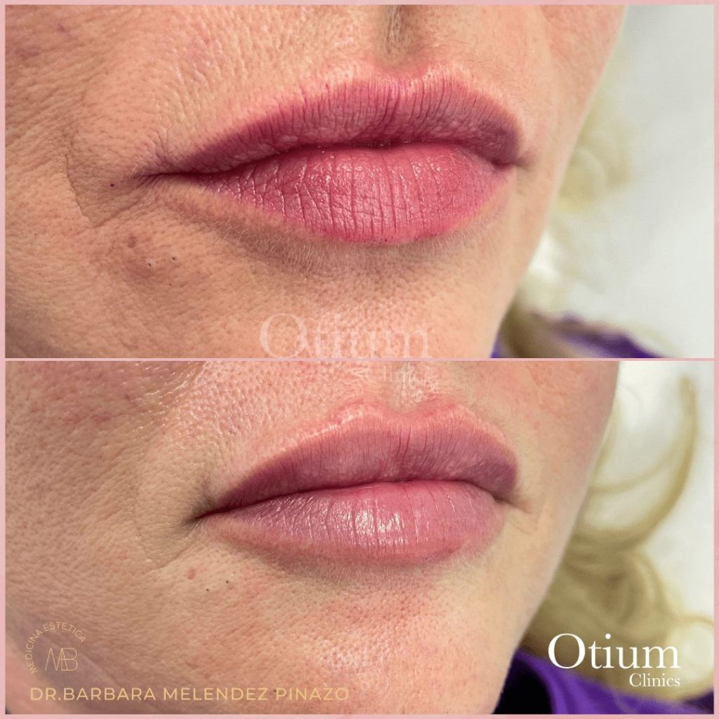 Labios - Otium Clinics